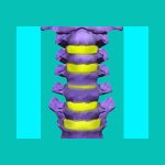 Collapsed Disc - Herniated Disc