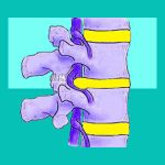 Diffuse Disc Bulge - Herniated Disc