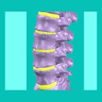 Disc Desiccation - Herniated Disc