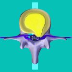Extruded Disc - Herniated Disc